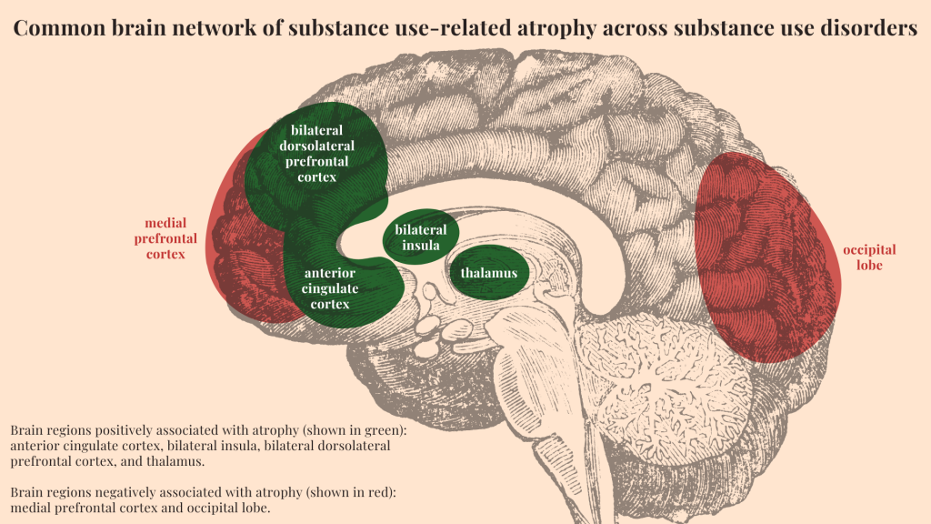 STASH, Vol. 19(13) – Is substance use-related brain atrophy localized ...